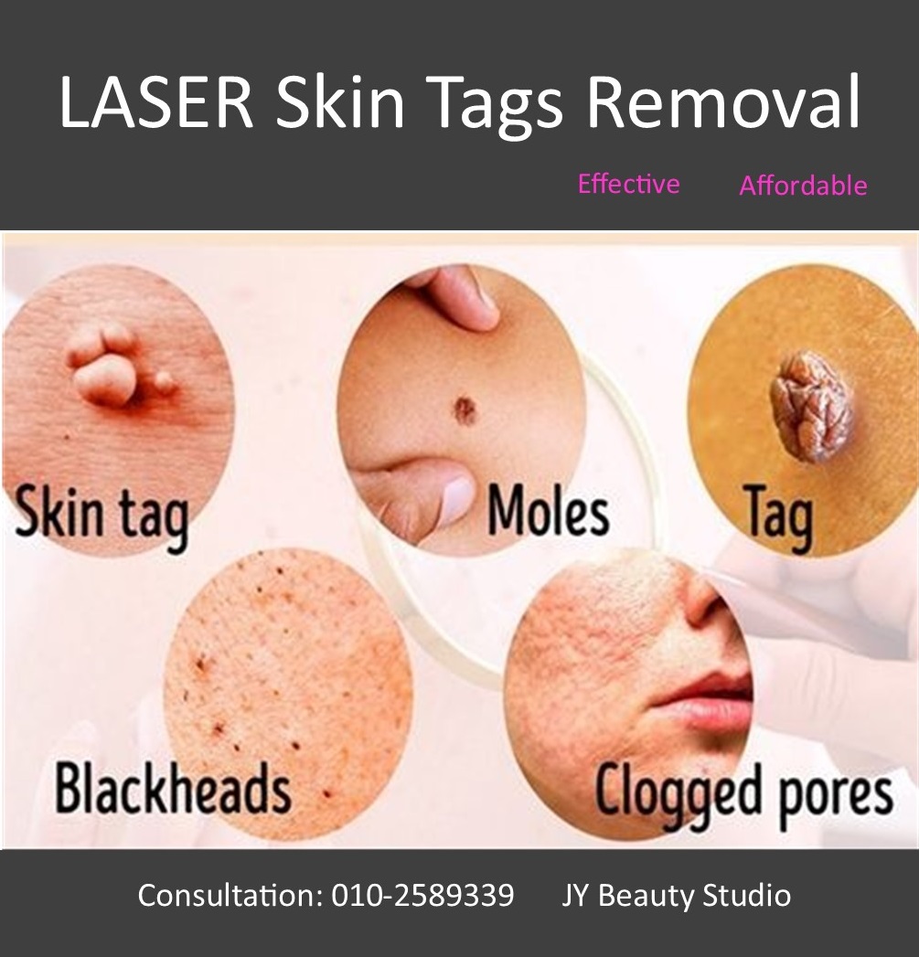 THE BEST and Affordable SKIN TAGS REMOVAL in KL PJ PUCHONG SUBANG ...